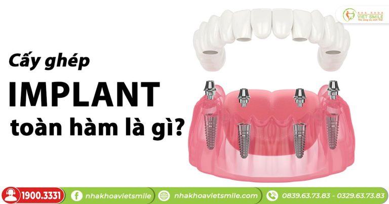 Trồng răng implant toàn hàm có ưu điểm gì? Cấy ghép implant toàn hàm