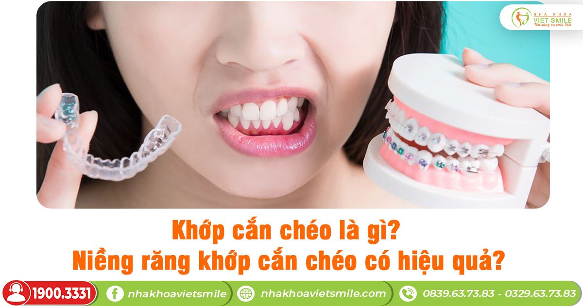 Khớp cắn chéo là gì? Nguyên nhân do đâu?